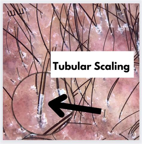Tubular Scaling In Lichen Planopilaris LPP Donovan Hair Clinic