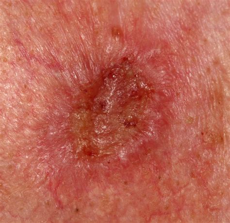 Squamous Cell Skin Cancer