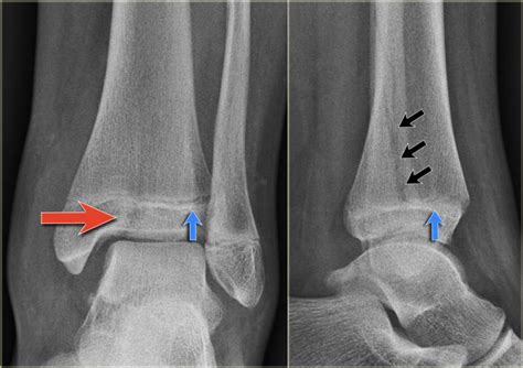 The Radiology Assistant Special Ankle Fractures