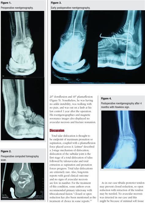Figure 1 From Closed Total Talar Extrusion After Ankle Sprain Semantic Scholar