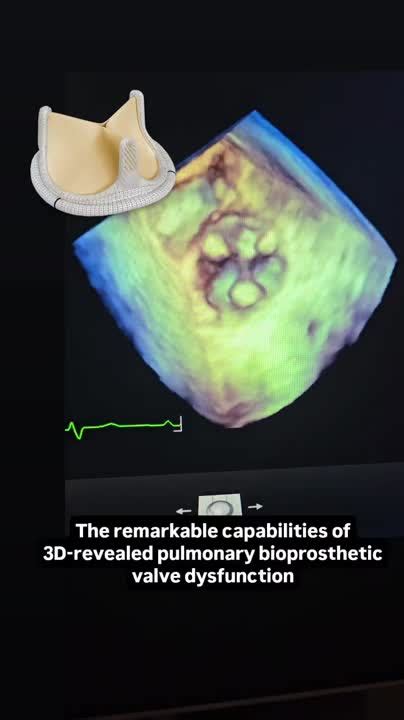 Farid Esmaeili On Linkedin Hearthealth Echocardiography Medicalimaging