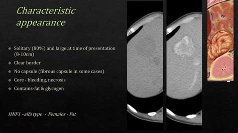 Imaging Of Benign Focal Hepatic Lesions Pptx
