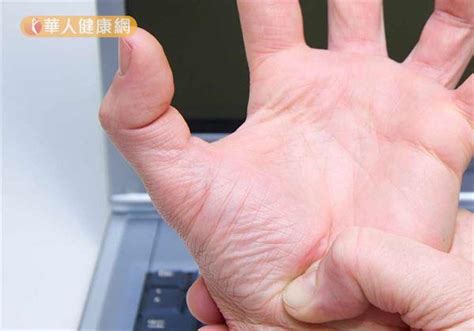 大手大腳臉型改變！揪出肢端肥大症 華人健康網 專業即時優質的健康新聞及資訊分享平台業即時優質的健康新聞及資訊分享平台