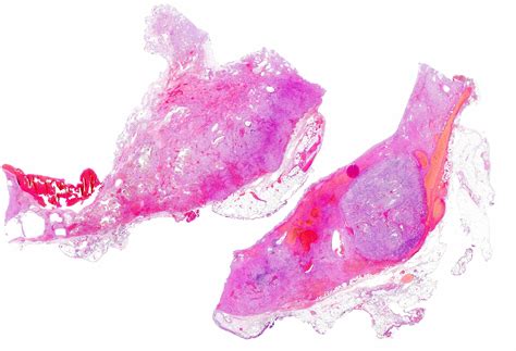 Pathology Outlines Gastrointestinal Stromal Tumor Gist