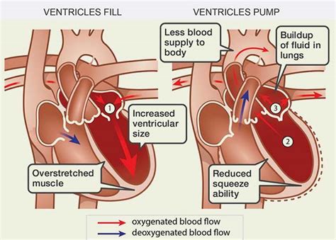 Dilated Cardiomyopathy Causes Complication And Prevention Tips