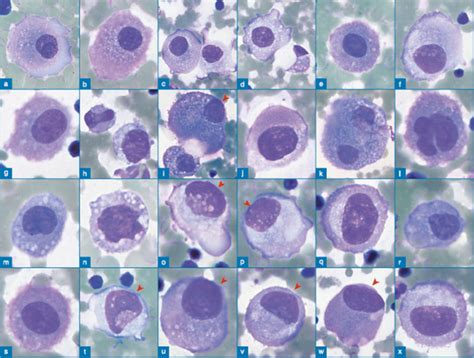 Serous Effusions Basicmedical Key