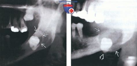 Рентгенограмма КТ при зубной кисте