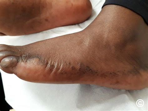 Palmoplantar Keratoderma