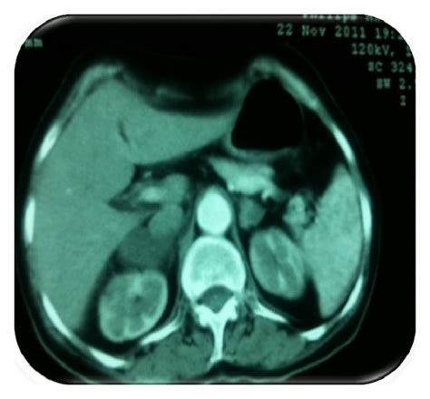 A Computed Tomography Of The Abdomen Shows A Bilateral Adrenal Mass