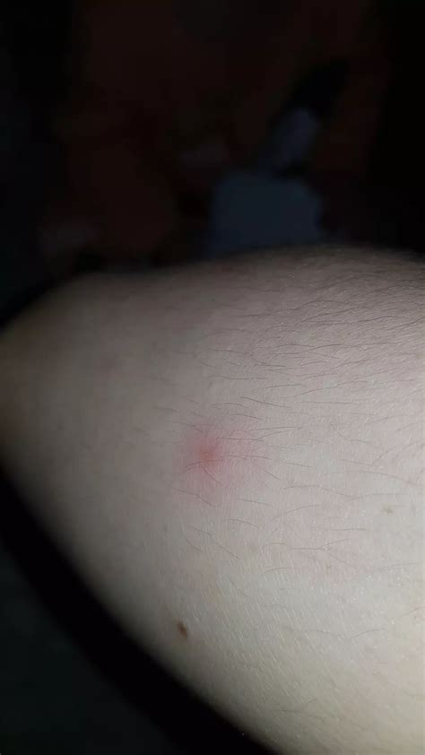 Что это за высыпания 14 числа был анальный секс с мужем 15 числа обнаружила Medaboutme