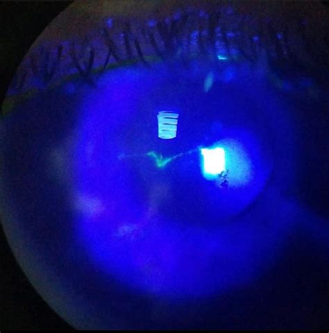 Management Of Corneal Abrasion Following Intravitreal Injection A Teaching Case Report The