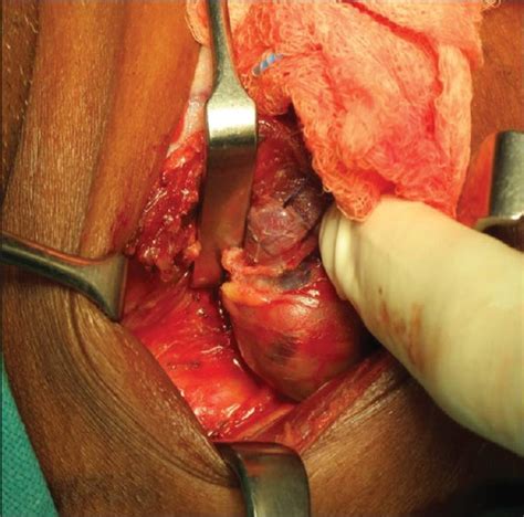 Hyperparathyroid Crisis Its Not All About Calcium Pmc