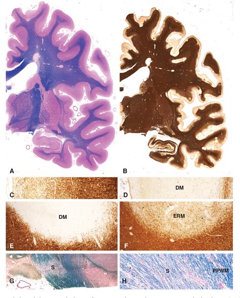 Figure 1 From Multiple Sclerosis Pathology Semantic Scholar