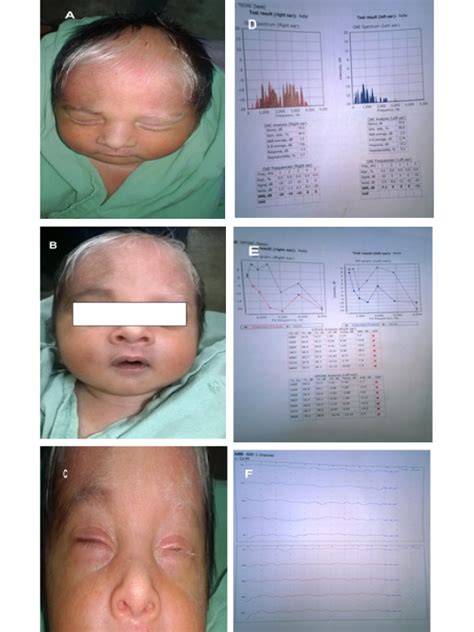 A Case Of Waardenburg Syndrome Type 1 International Journal Of