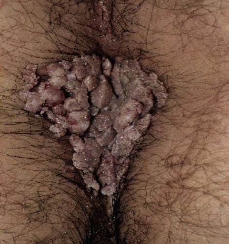 Ch 17 Reproductive And Perineum Flashcards Quizlet