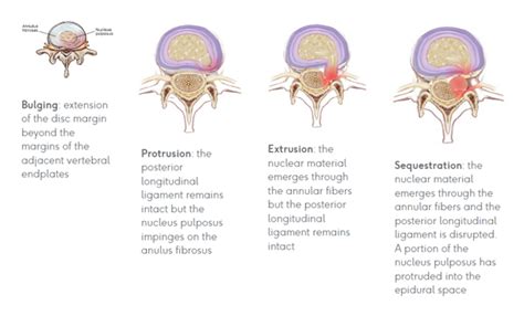 Spinal Herniated Disc Clearcut Physiotherapy