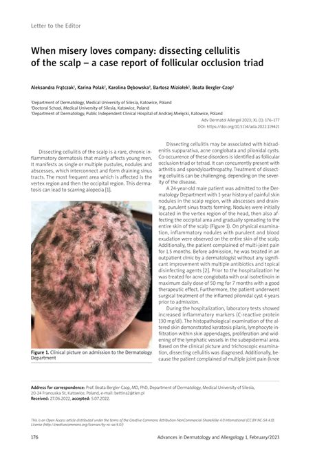 Pdf When Misery Loves Company Dissecting Cellulitis Of The Scalp A Case Report Of