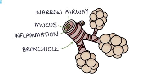 Bronchiolitis Flashcards Quizlet