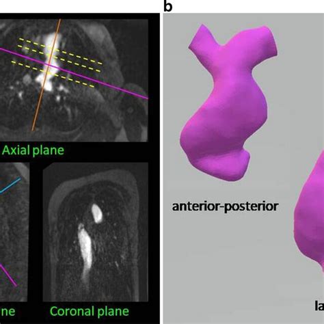 Measurements Of The Right Ventricular Outflow Tract At Four Points In