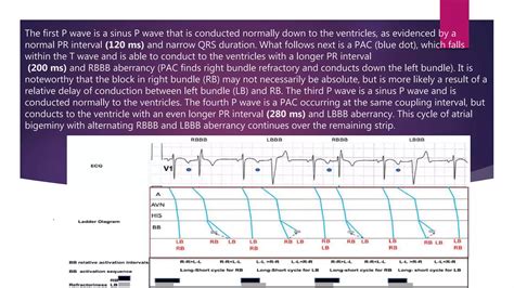 Interesting Ecg Tracing 1 Alternating Bundle Branch Block Pptx