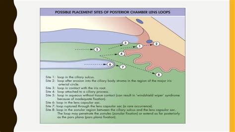 Evolution Types Materials Of Iol Pptx