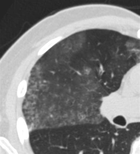 Nodules Centrilobular The Common Vein