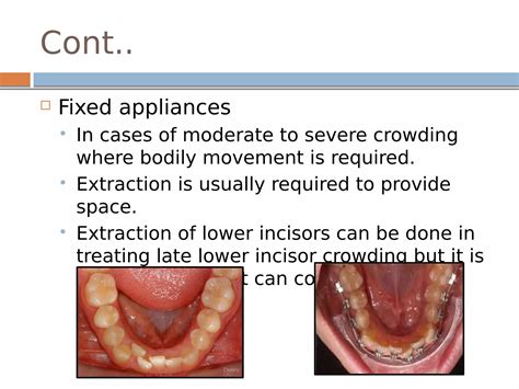 262054548 Late Lower Incisor Crowdingpdf
