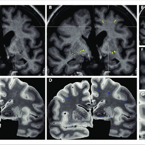 Vrs Post Mortem Mri Histology A Post Mortem Mri From Subject Download Scientific Diagram