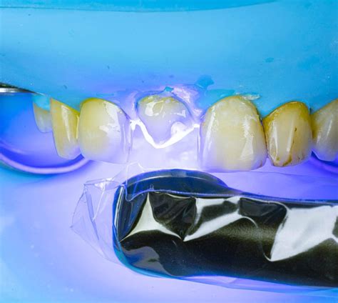 Direct Composite Veneers A Step By Step Protocol Myzerodonto