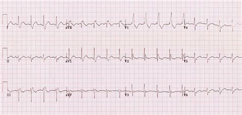 The Boring Guide To Ecgs Fascicular Blocks Canadiem