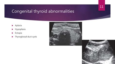 Approach To Thyroid Mass Pptx