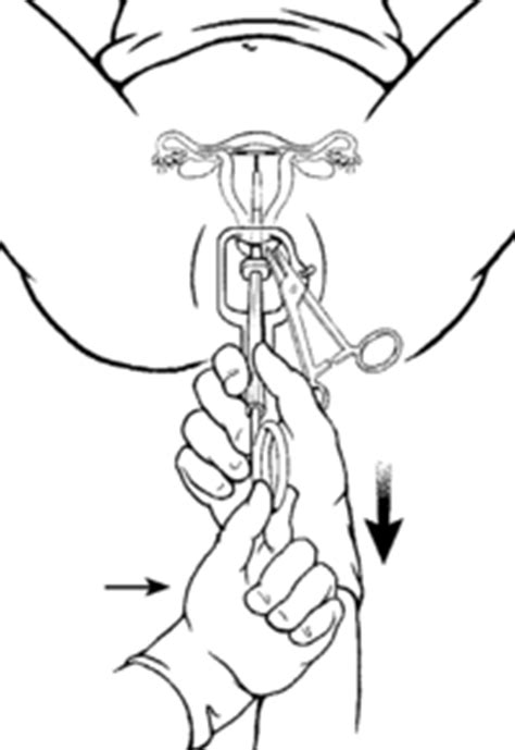 Inserting An IUD Hesperian Health Guides