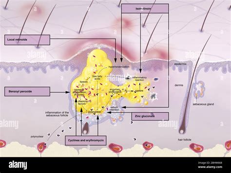 Hyperkeratinization Acne