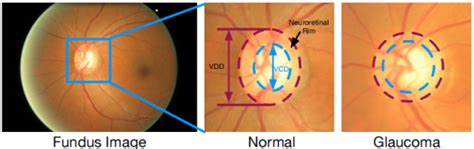 github transmux eyediseasedetect