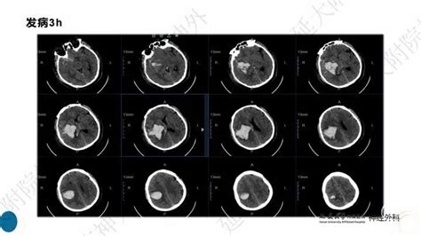 监测有道丨右侧基底节区大量脑出血内镜下血肿清除术——颅脑创伤 神经重症周刊（第323期） 脑医汇