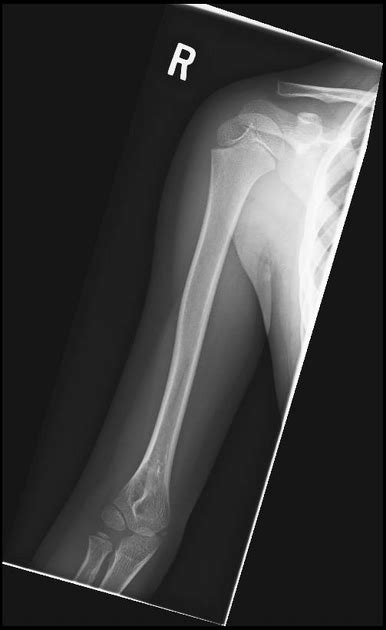 Humerus X Ray
