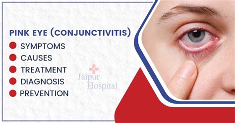 Conjunctivitis Causes Symptoms Precautions And Treatments Conjunctivitis Prevention Jethro Jeff