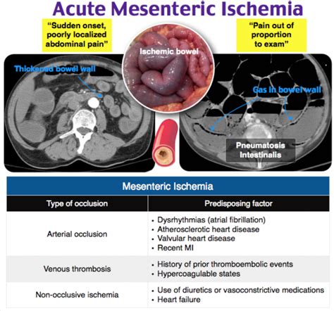 Emergency Medicine Educationem 3am Mesenteric Ischemia Emergency