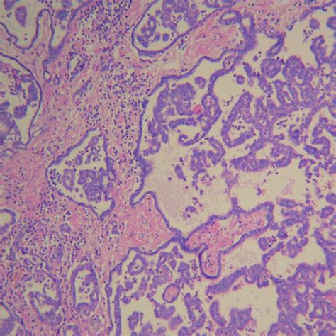 The Most Frequent Type Is Epithelioid Malignant Mesothelioma