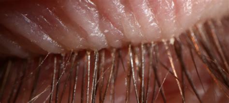Eyelash Mites Symptoms Causes And Treatment Vision Direct Au