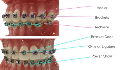 Braces Wire Pokey What To Do