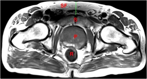 Normalized Periprostatic Fat Mri Measurements Can Predict Prostate