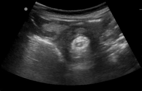 Intussusception Archives Pocus Journal
