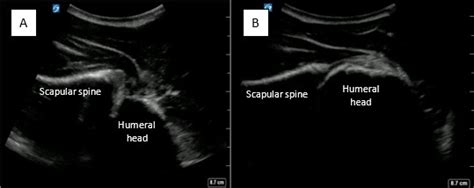 Pediatric Interscalene Nerve Block For Shoulder Dislocation And
