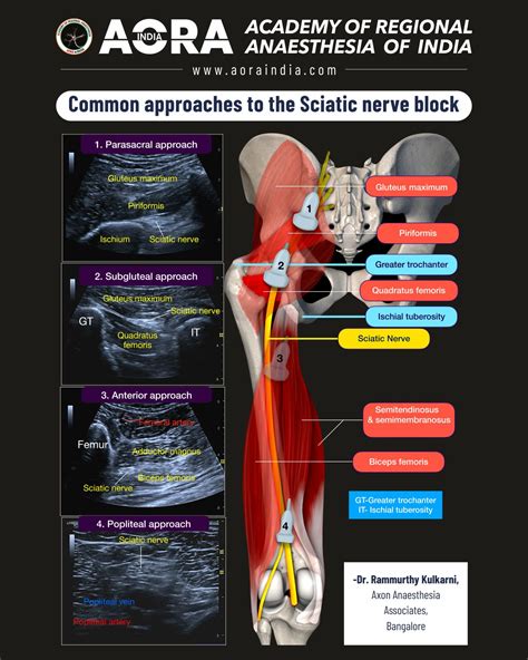 Sciatic Nerve Block