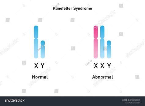 Sindrome De Klinefelter Quadrado Punnett Down Syndrome Brochure By