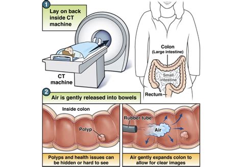 Best Virtual Colonoscopy Diagnostic Center Atlas Diagnostic Imaging
