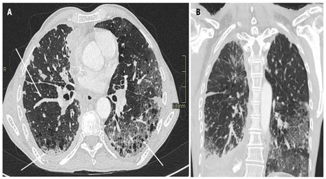 Evaluation Of Parenchymal Thyroid Diseases With Multiparametric
