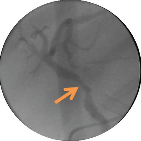 Surgical Procedure Of Ercp In The Treatment Of Biliary Strictures After