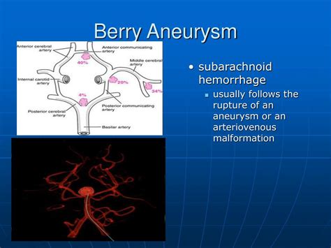 Ppt Cvd Stroke Septemius A Pansacola Rn Md Powerpoint Presentation